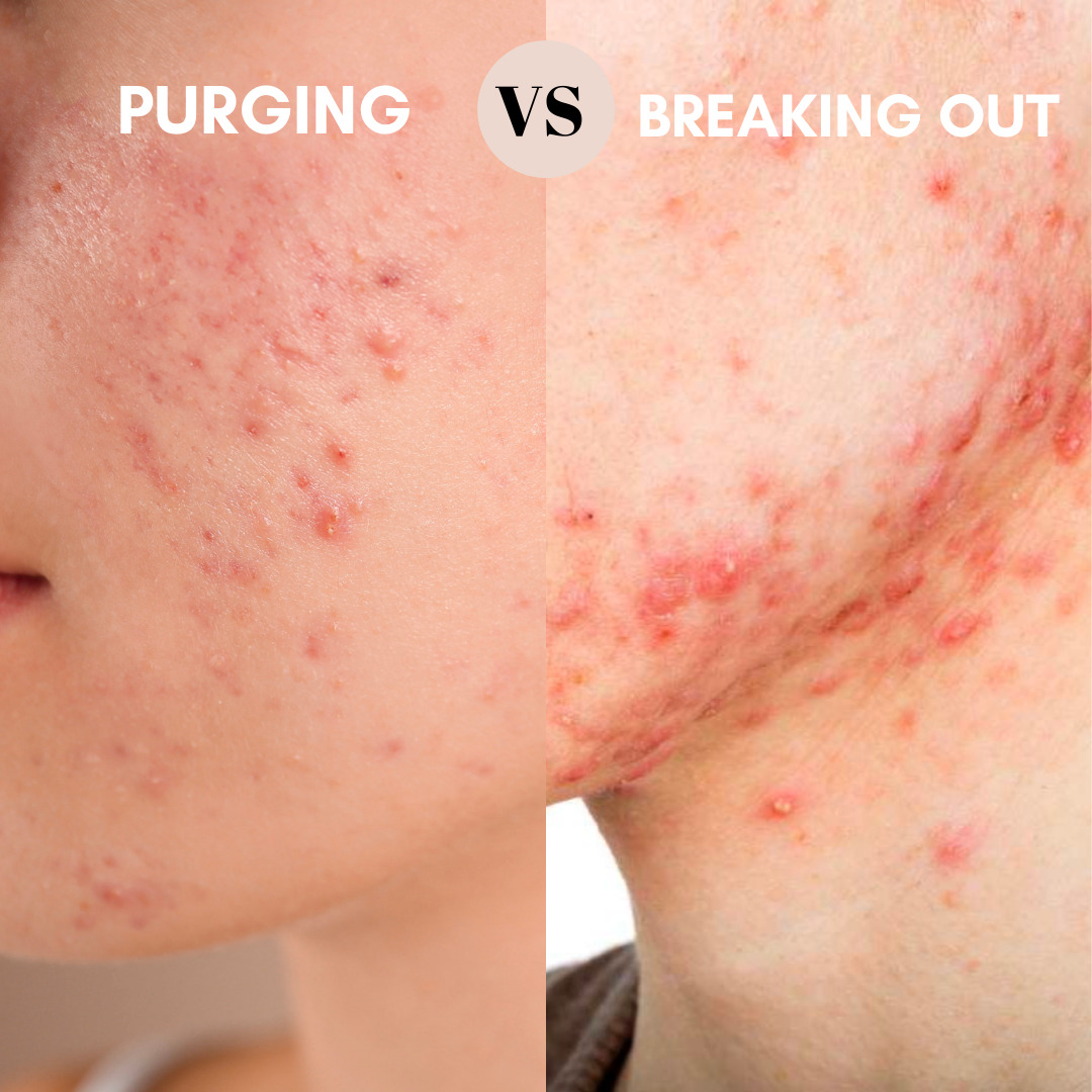 Purging Vs Breaking Out Are You Just Breaking Out Healthy Skin Glows Purging Vs Breaking Out Are You Just Breaking Out Healthy Skin Glows